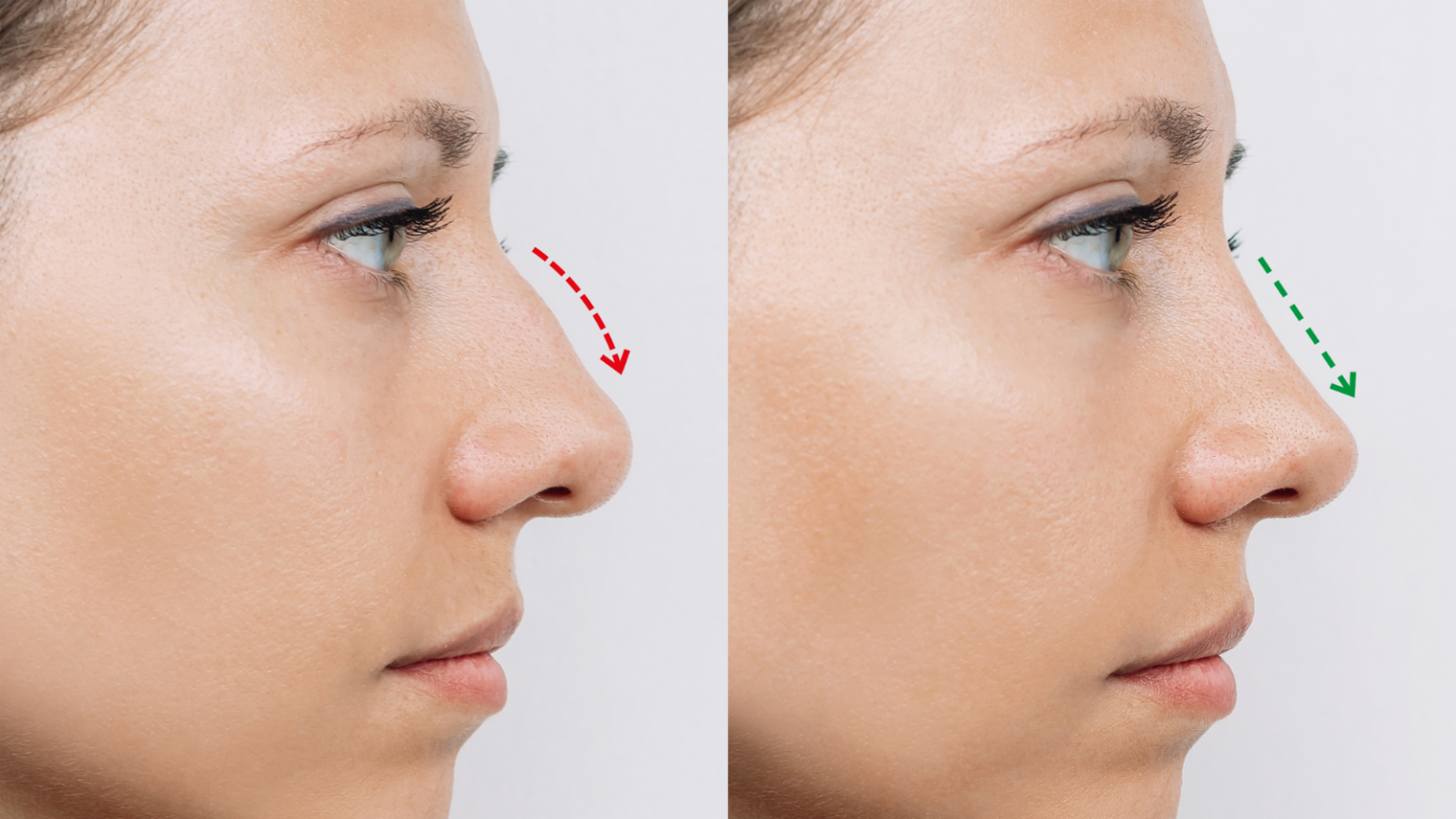 Functional vs Cosmetic Rhinoplasty – Explained by Dr. Tawar
